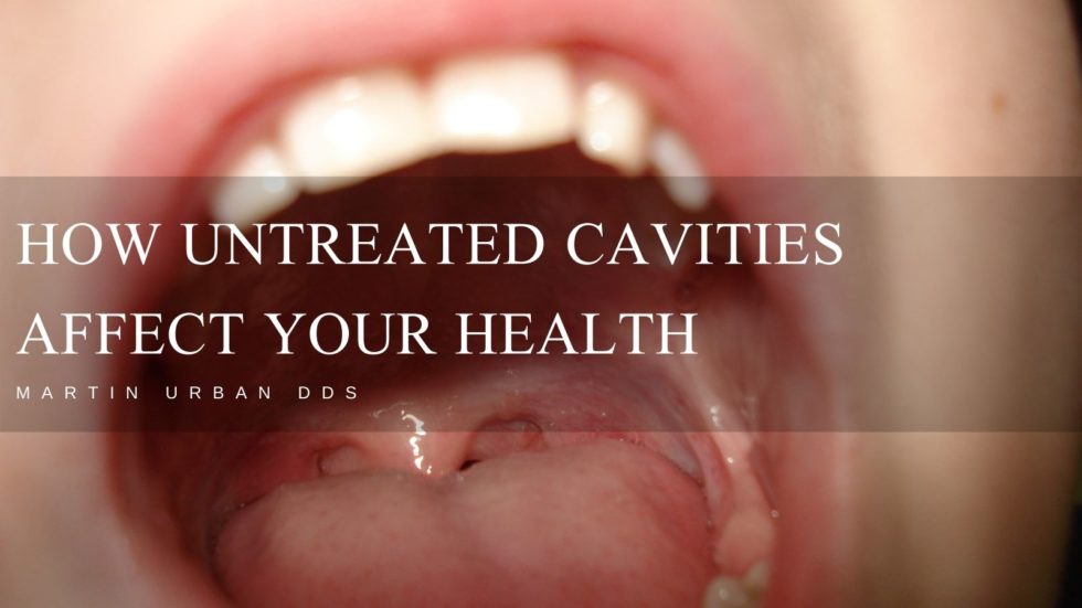 How Untreated Cavities Affect Your Health | Martin Urban DDS ...